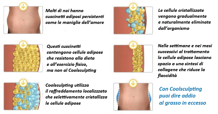 Coolsculpting - Criolipolisi - San Luca Medical
